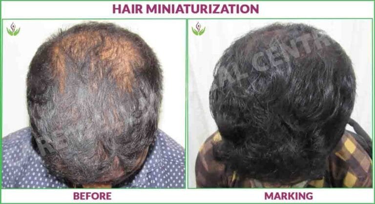 Hair Miniaturization Treatment in Delhi - Stop Hair Thinning | Care ...