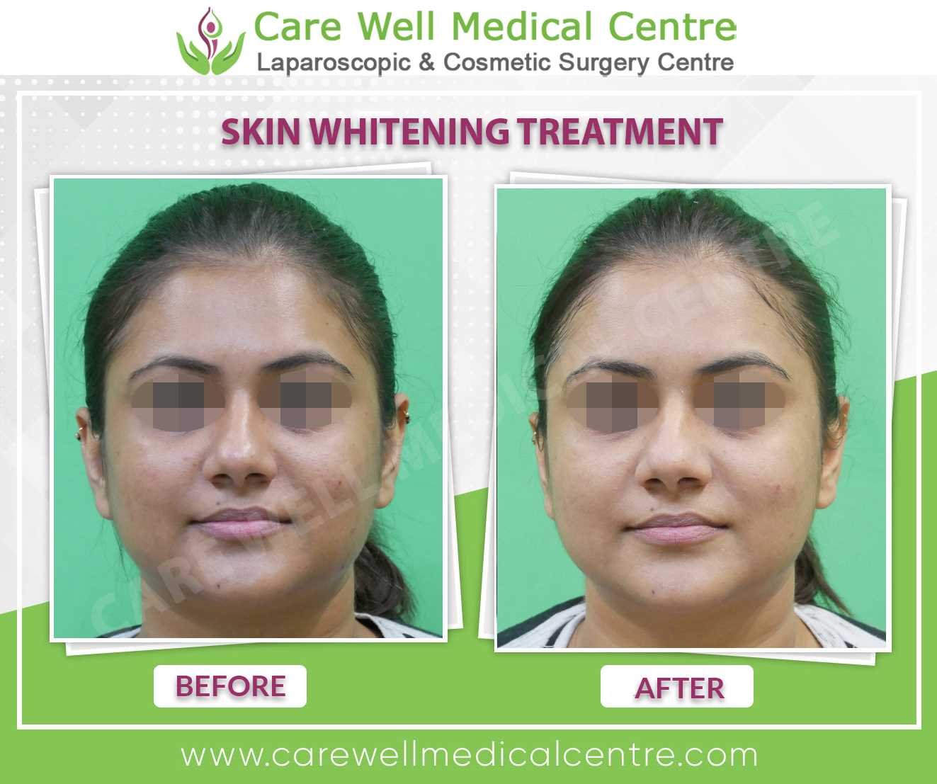 Skin Whitening Treatment in Delhi – Cost, Before and After Results ...