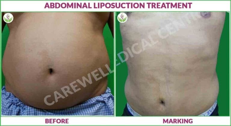 Best Liposuction in Delhi – Cost, Results, and Recovery | Care Well ...