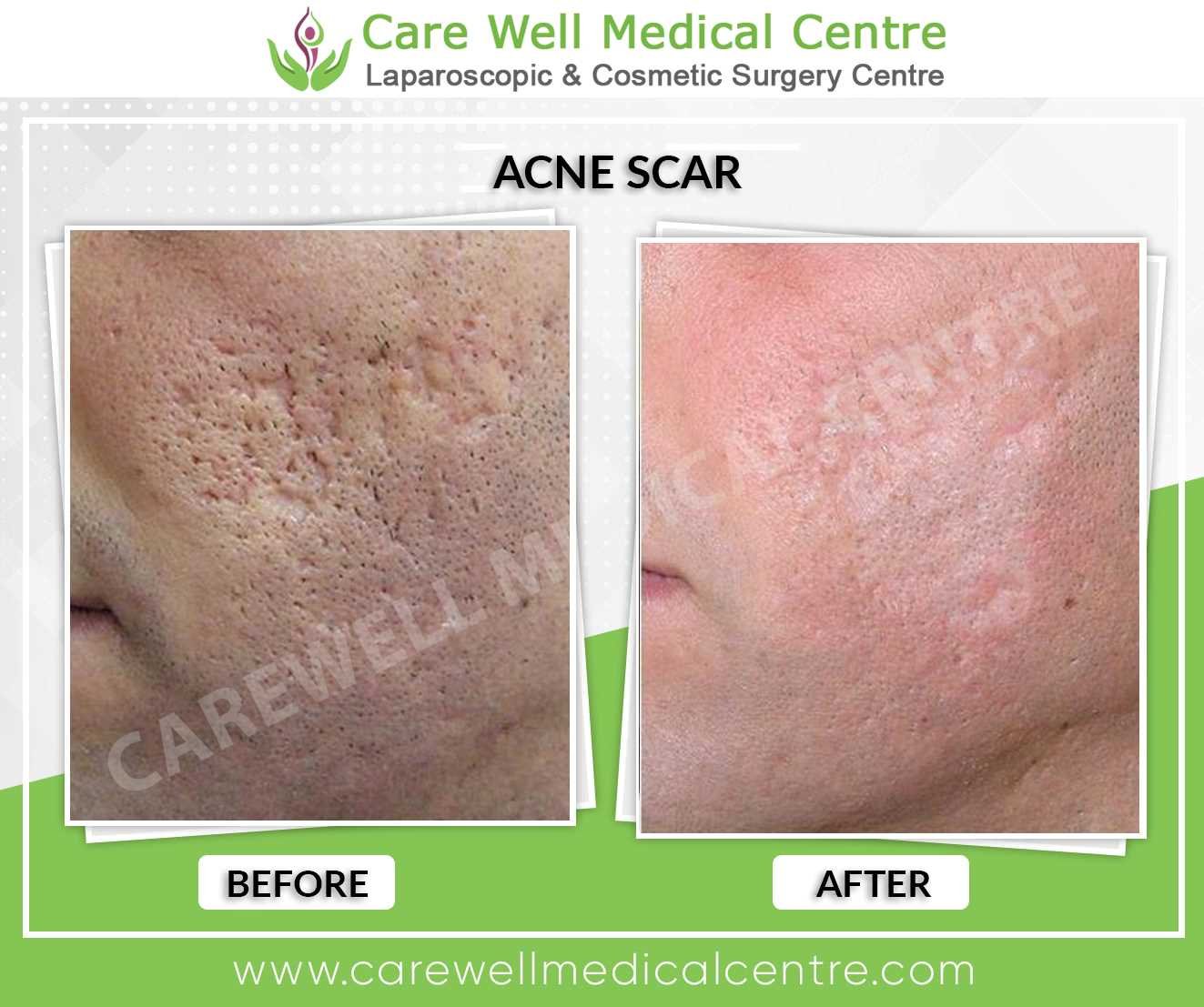 Acne Scar Treatment in Delhi | Cost, Sessions & Care Plans | Care Well ...