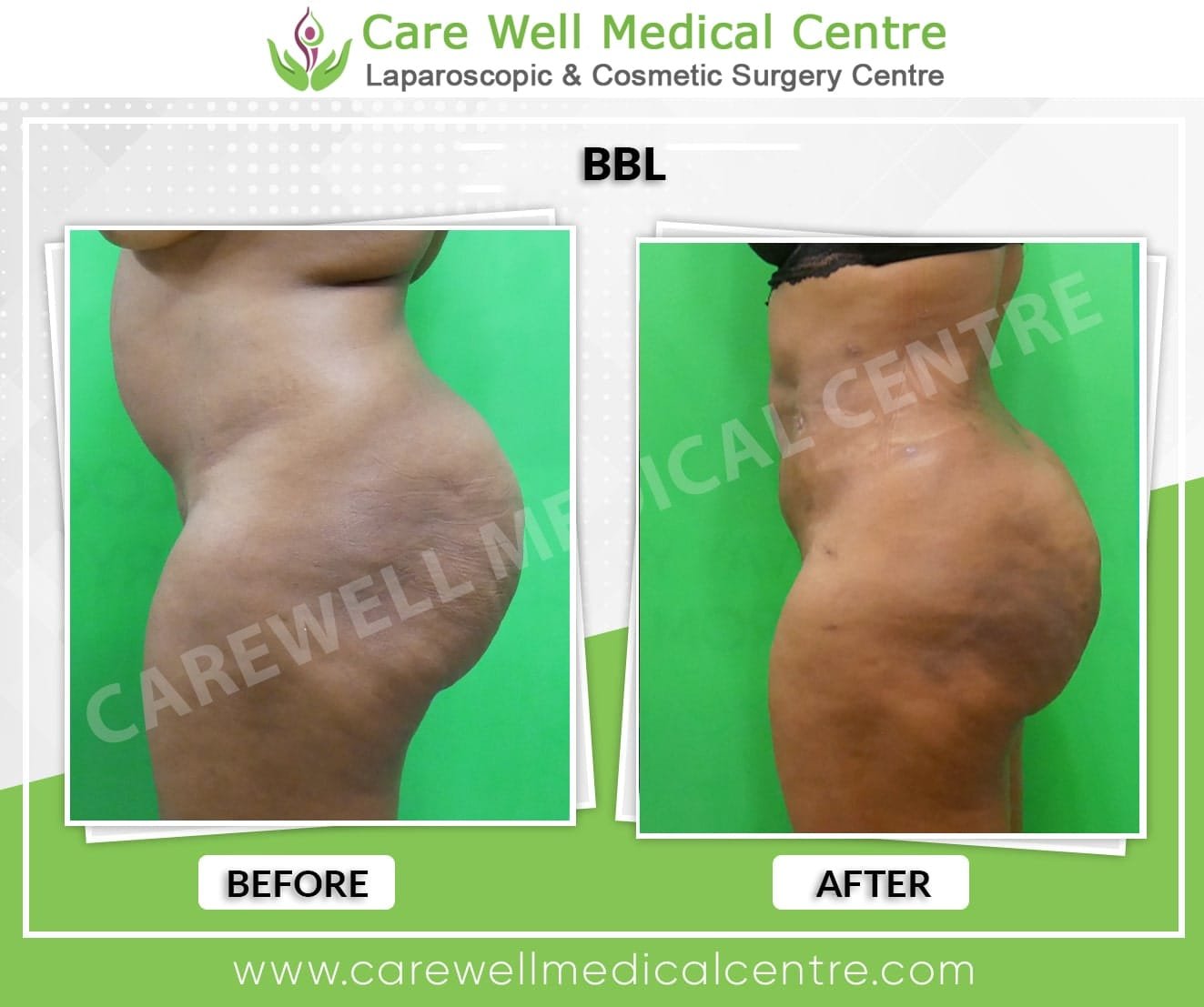 Brazilian Butt Lift (BBL) in Delhi - Cost, Recovery & Experts | Care Well Medical Centre