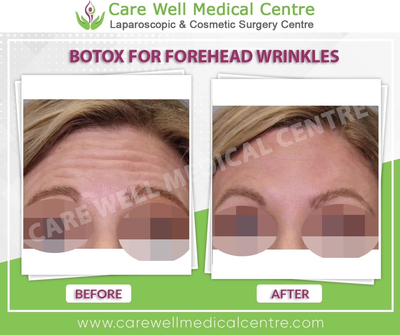 Botox for Forehead Wrinkles in Delhi - Cost & Results | Care Well ...
