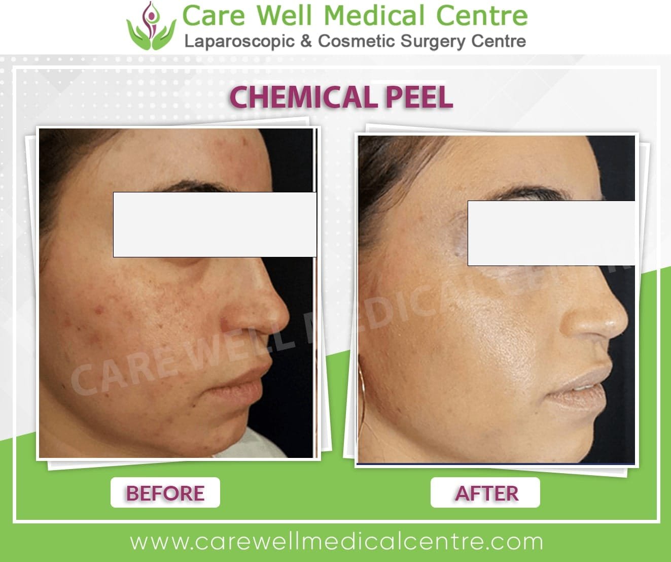 Chemical Peel Treatment in Delhi | Cost, Before & After Results | Care ...