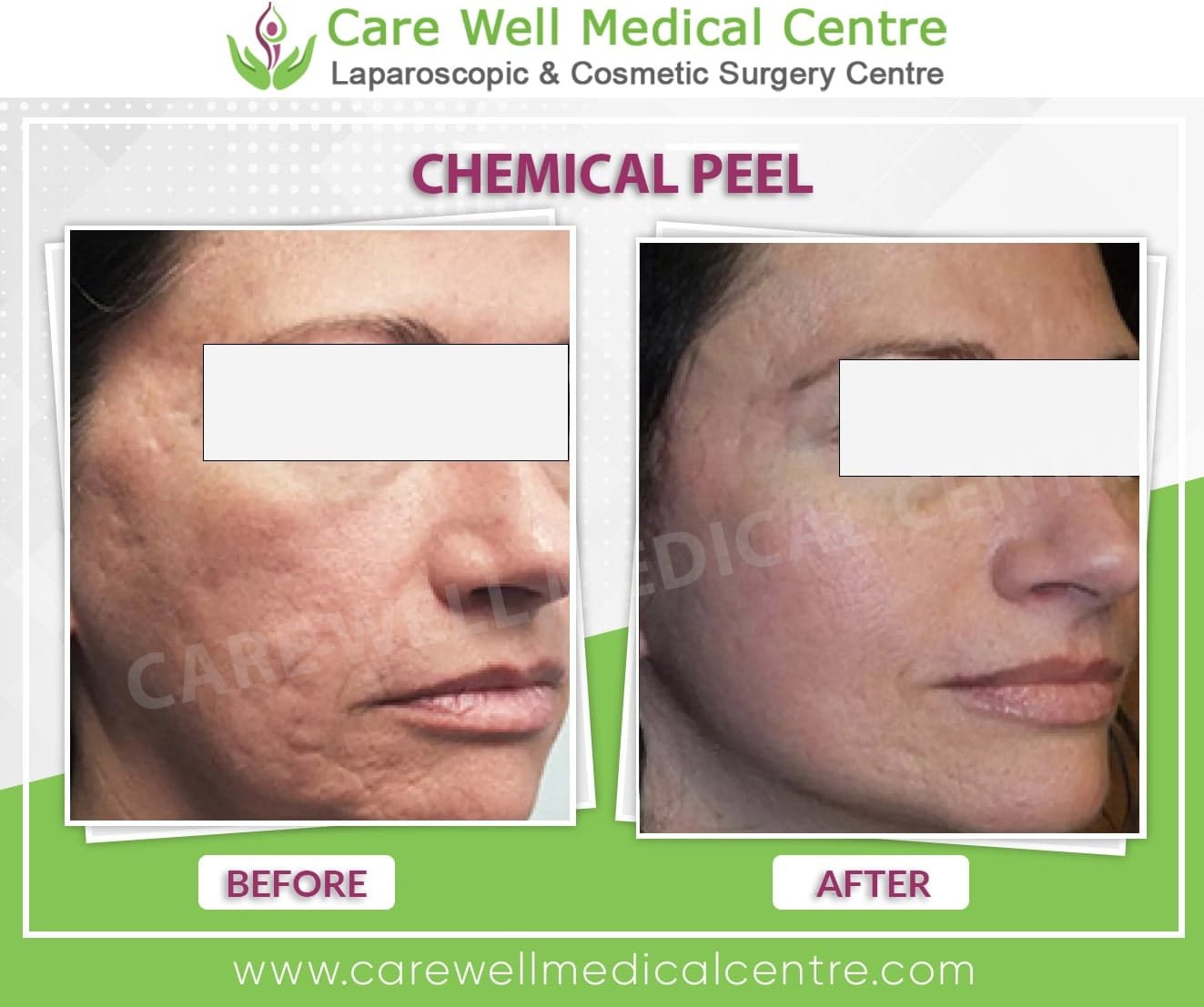 Chemical Peel Treatment in Delhi | Cost, Before & After Results | Care ...