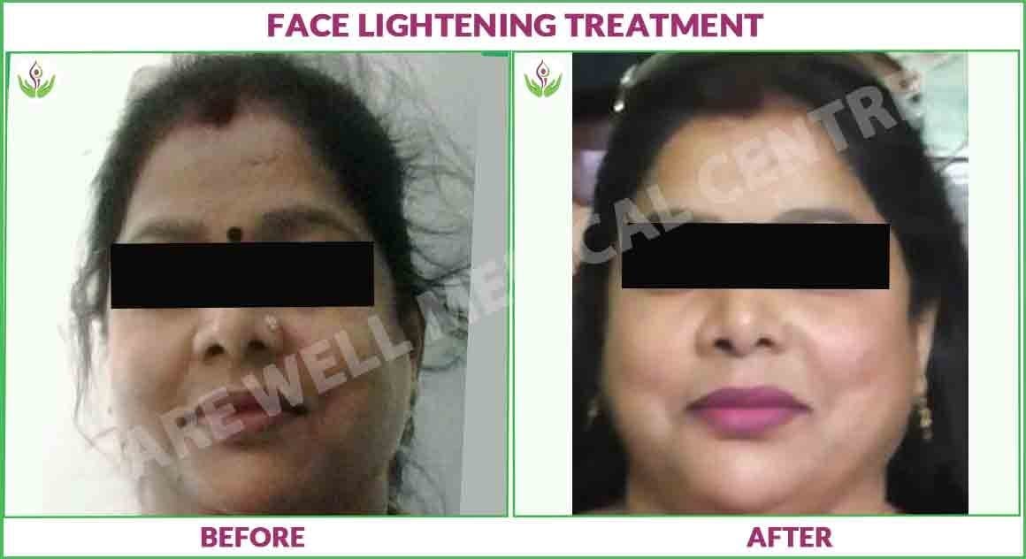 Anti Aging Treatment in Delhi | Cost, Results & Youthful Skin | Care ...