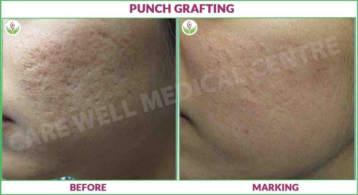 Punch Grafting in Delhi - Skin Repair for Scars, Wounds & Vitiligo ...