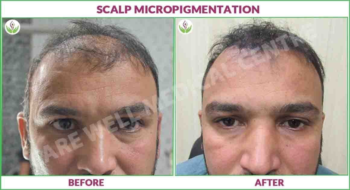 Scalp Micropigmentation in Delhi | Cost, Before & After Results | Care ...