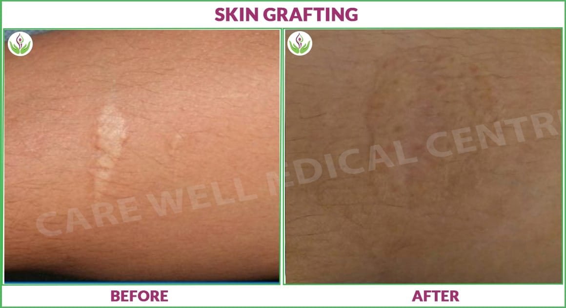 Skin Grafting in Delhi - Burn, Scar & Wound Repair Surgery | Care Well ...