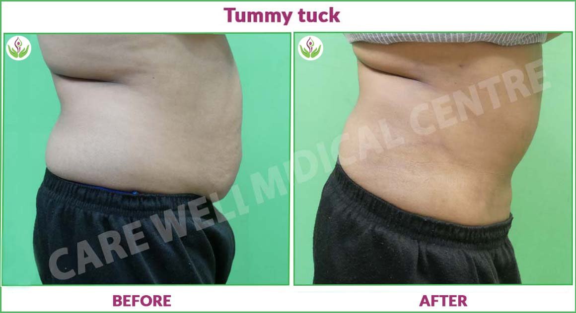 Tummy Tuck Surgery in Delhi | Care Well Medical Centre