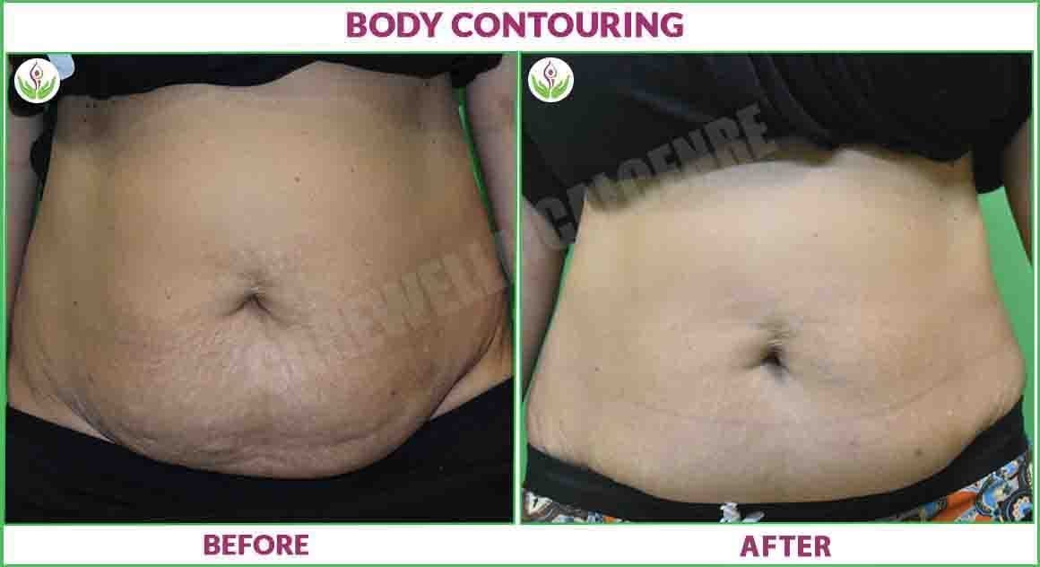 Body Contouring in Delhi – Cost, Fat Reduction & Sculpting | Care Well ...